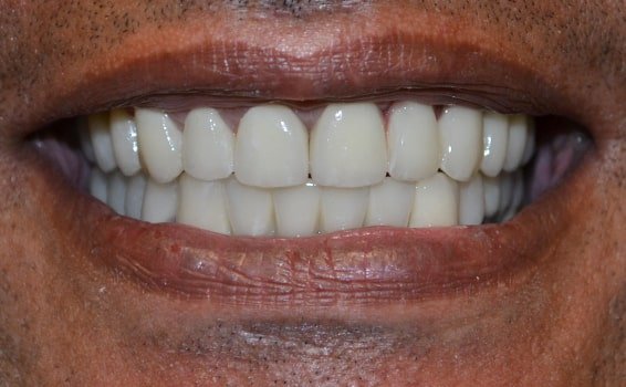 Prix prothèse dentaire fixe en 2024 : consulter les tarifs