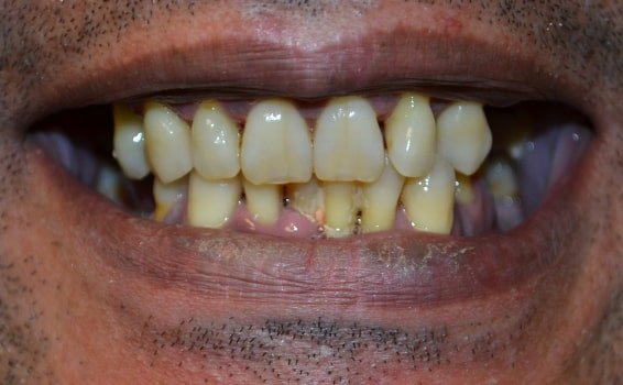 Prix prothèse dentaire fixe en 2024 : consulter les tarifs