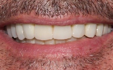 Prothèse Dentaire sur Implant (Dentier Fixe) : le guide complet