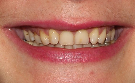 Prix prothèse dentaire fixe en 2024 : consulter les tarifs